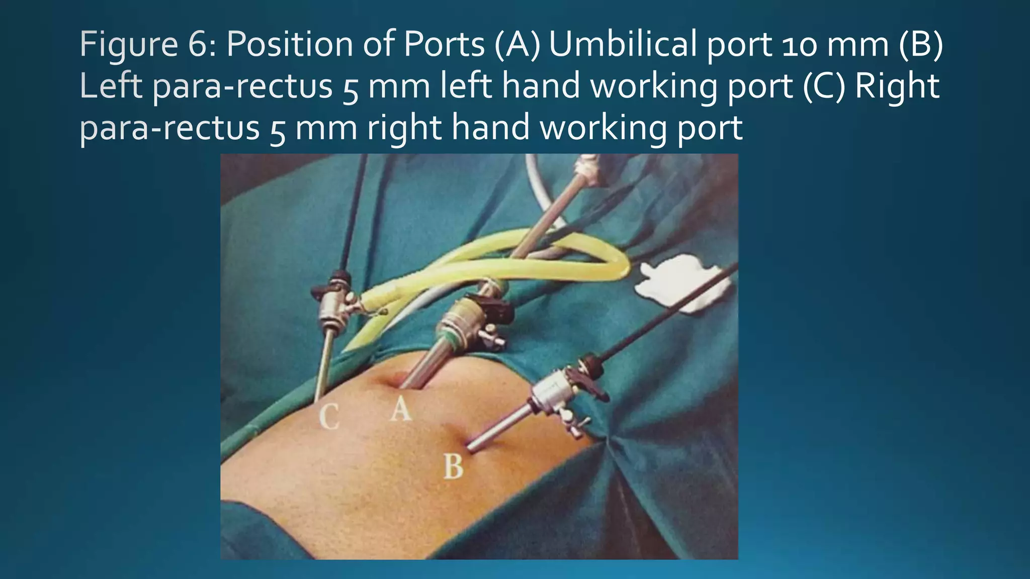 Laparoscopic repair of hernia- A Guide to Laparoscopic Hernia Surgery ...