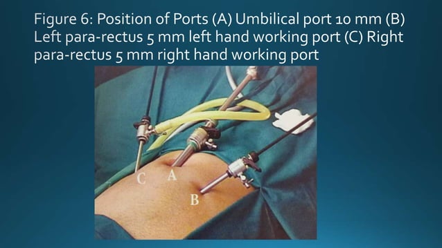 Laparoscopic repair of hernia- A Guide to Laparoscopic Hernia Surgery | PPTX