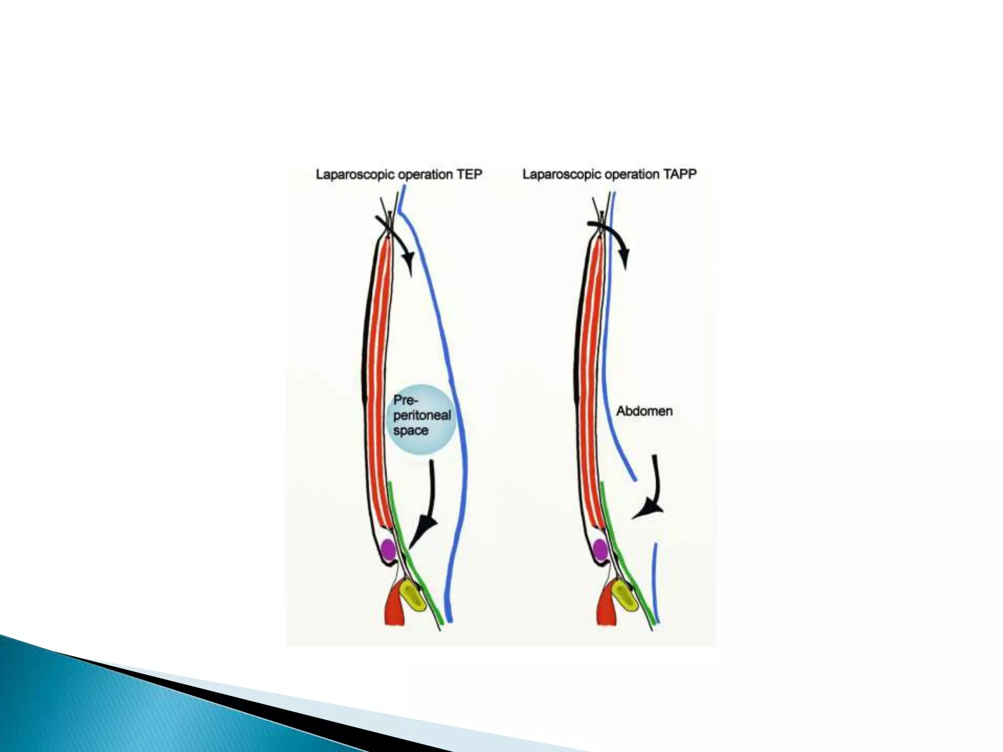 Laparoscopic Repair Of Inguinal Hernia Pptx 5899