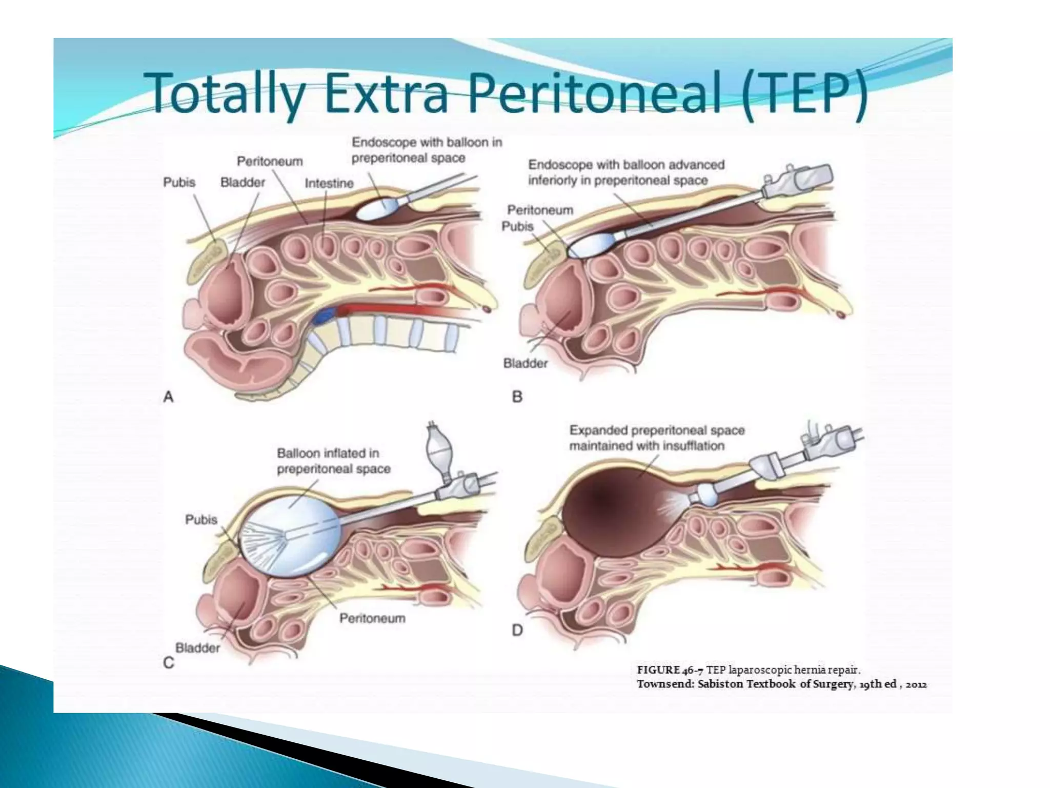 Laparoscopic repair of inguinal hernia | PPTX