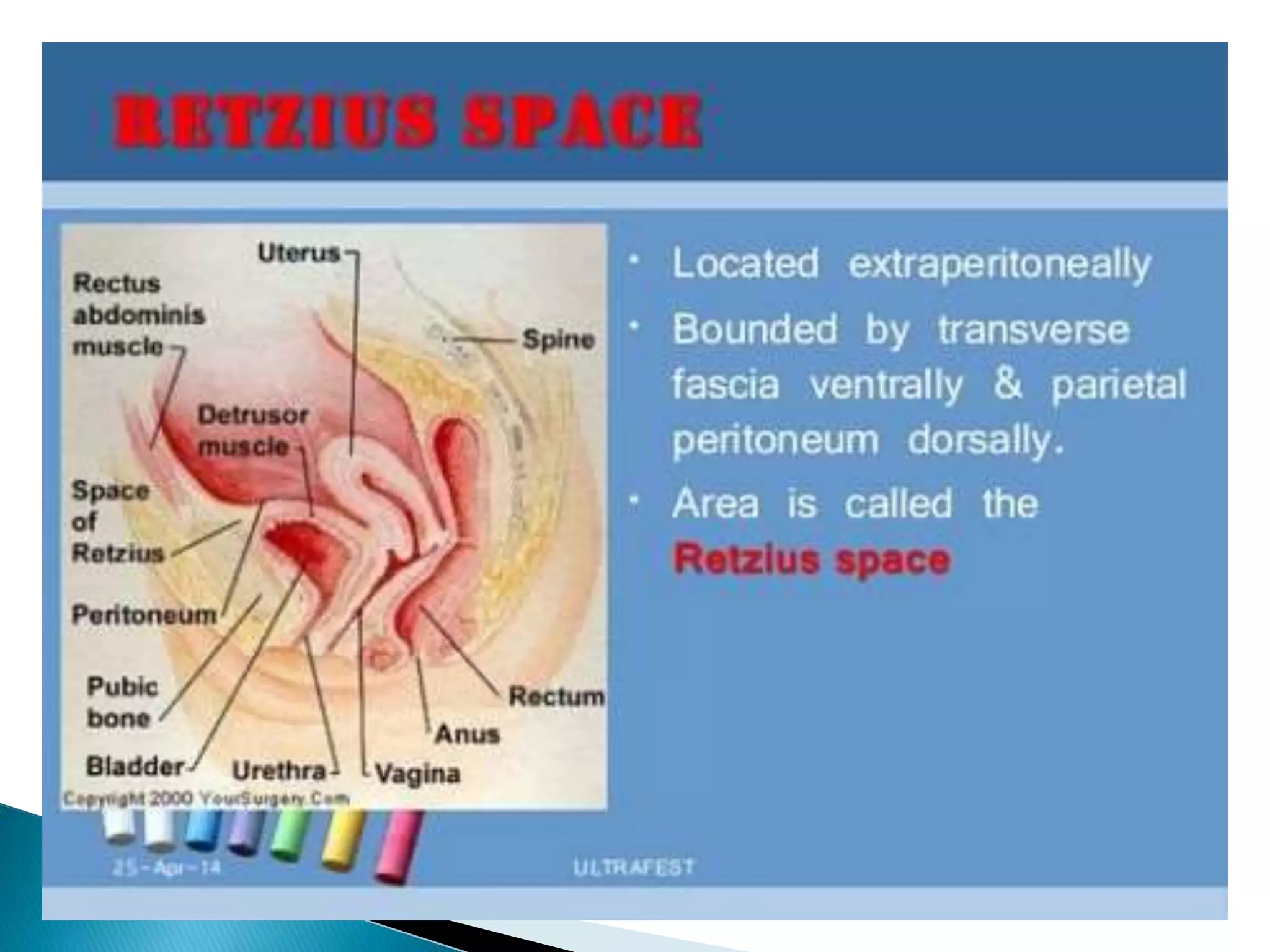Laparoscopic Repair Of Inguinal Hernia Pptx 2102