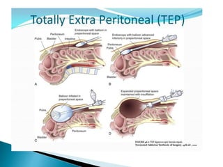 Laparoscopic repair of inguinal hernia | PPTX