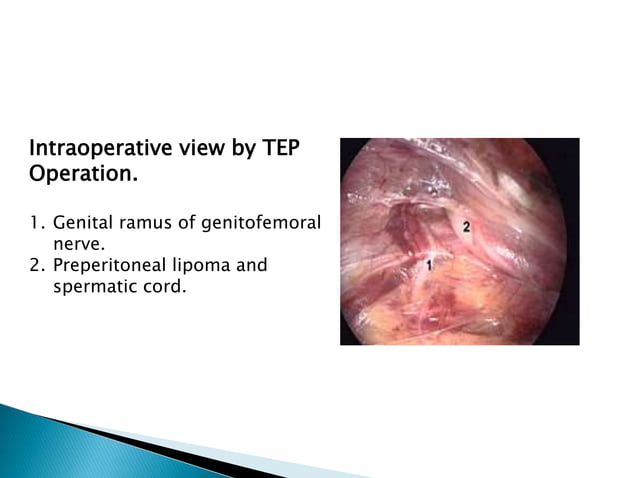 Laparoscopic Repair Of Inguinal Hernia Pptx 3075