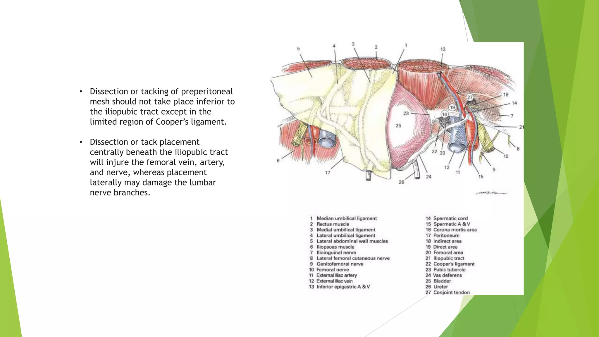 Laparoscopic retroperitoneal triple neurectomy | PPTX