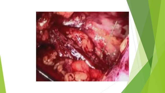 Laparoscopic retroperitoneal triple neurectomy | PPT