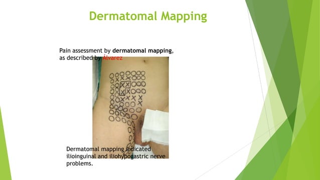 Laparoscopic retroperitoneal triple neurectomy | PPT