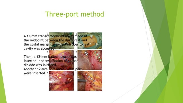 Laparoscopic retroperitoneal triple neurectomy | PPT