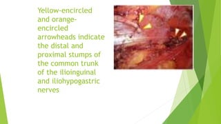 Laparoscopic retroperitoneal triple neurectomy | PPTX