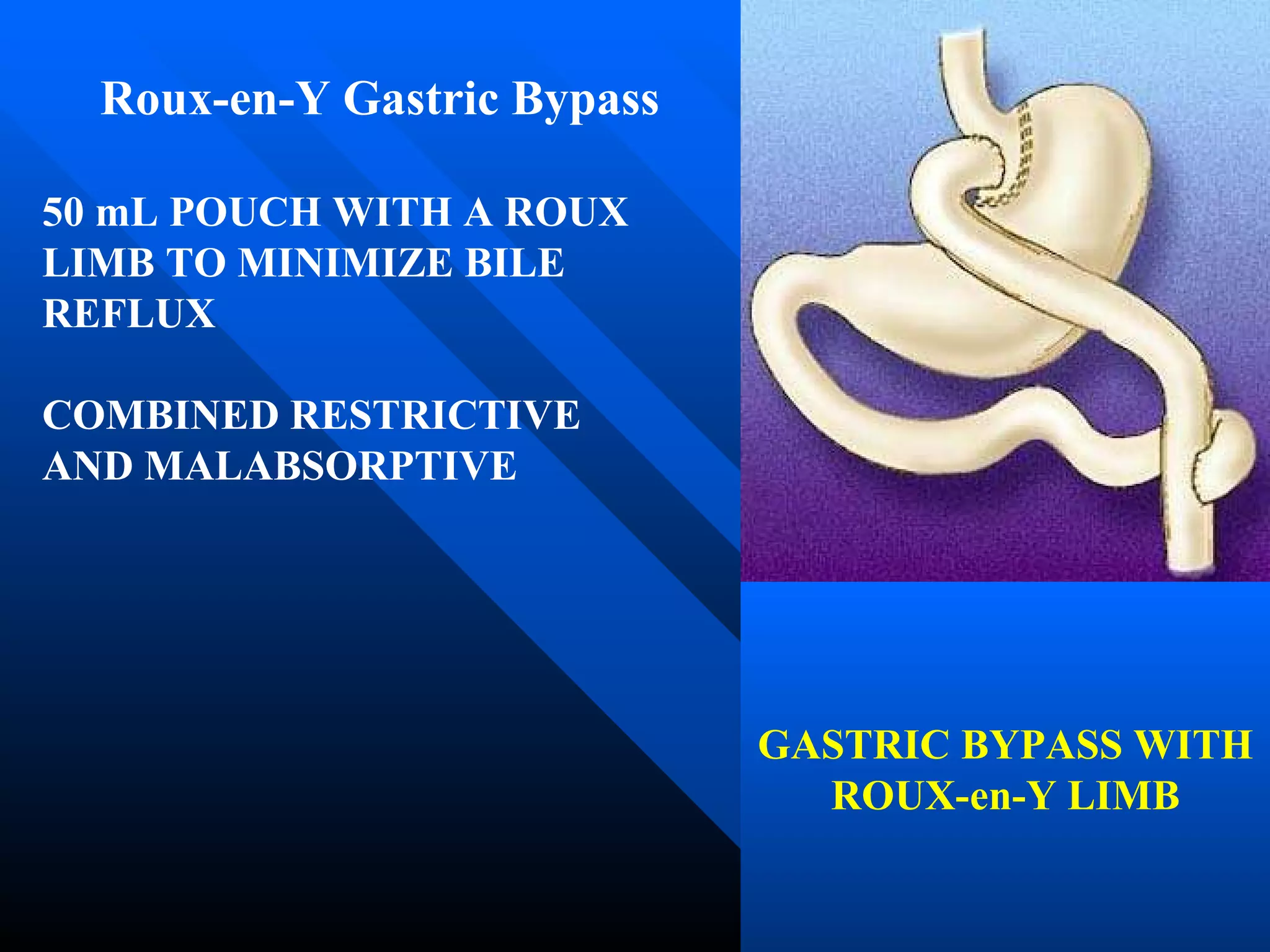 Laparoscopic Roux En-Y-Gastric Bypass: One Surgeon's Technique | PPT