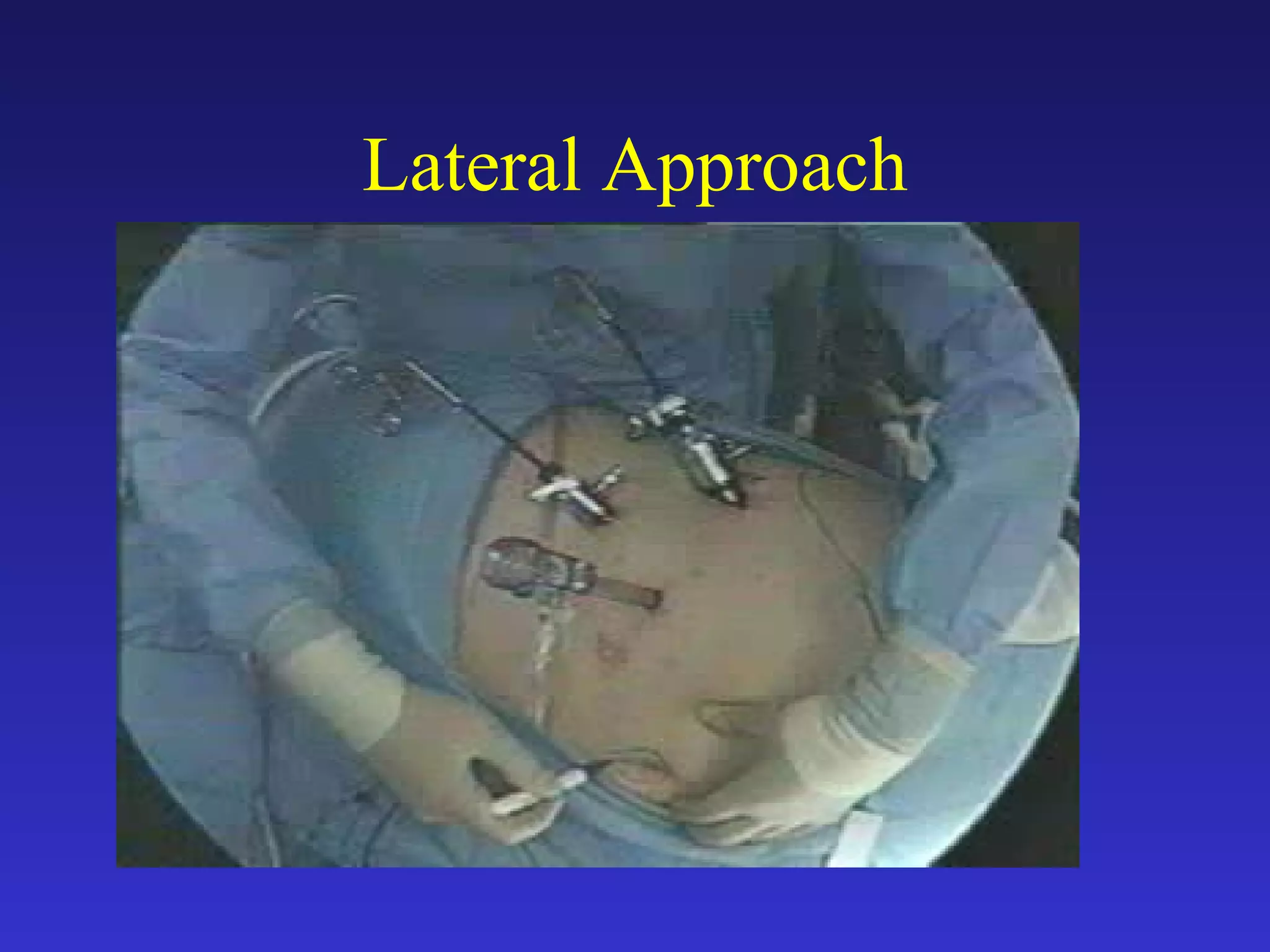 Laparoscopic Sigmoid Colon Resection for Diverticular Disease | PPT
