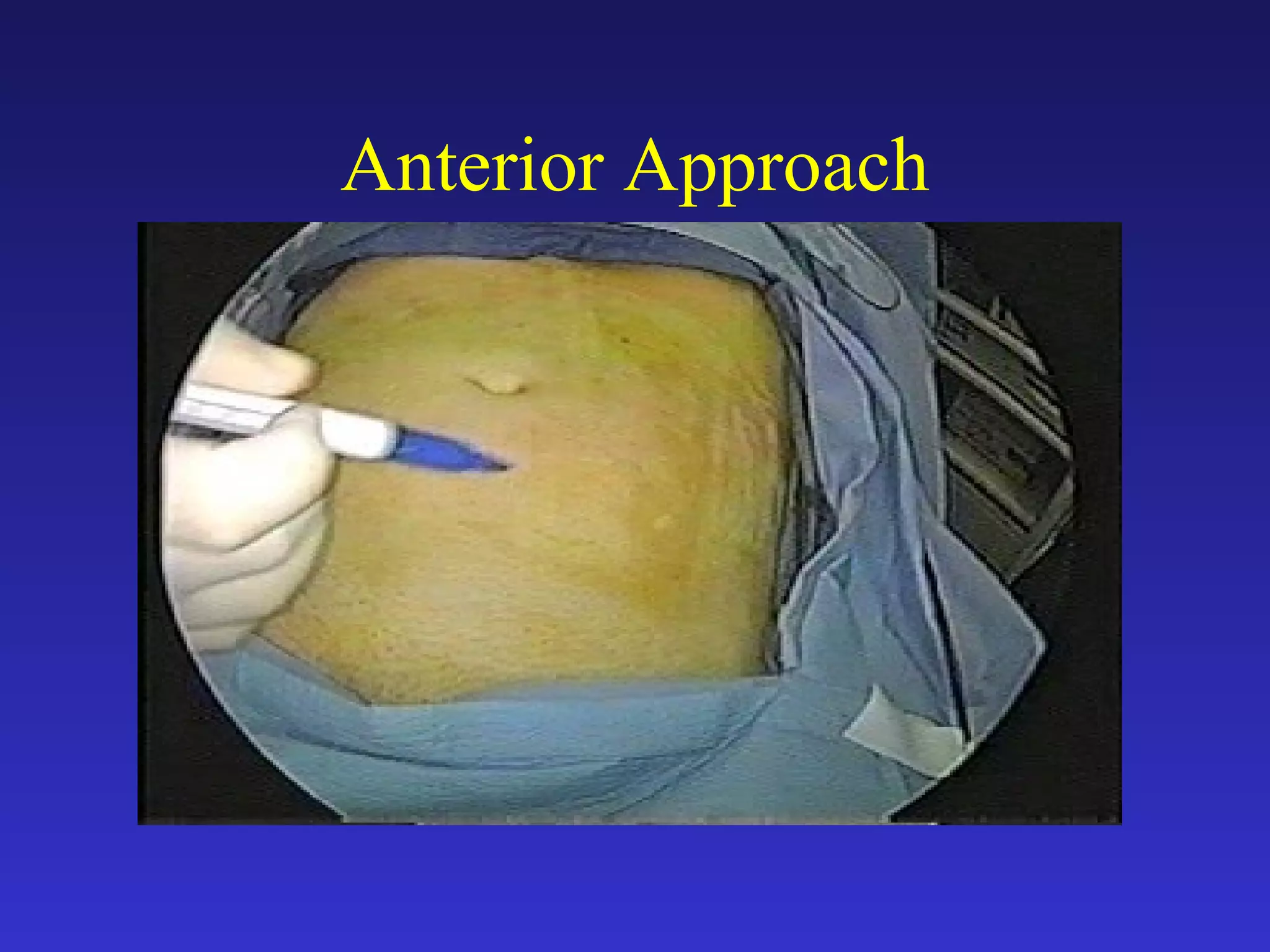 Laparoscopic Sigmoid Colon Resection for Diverticular Disease | PPT