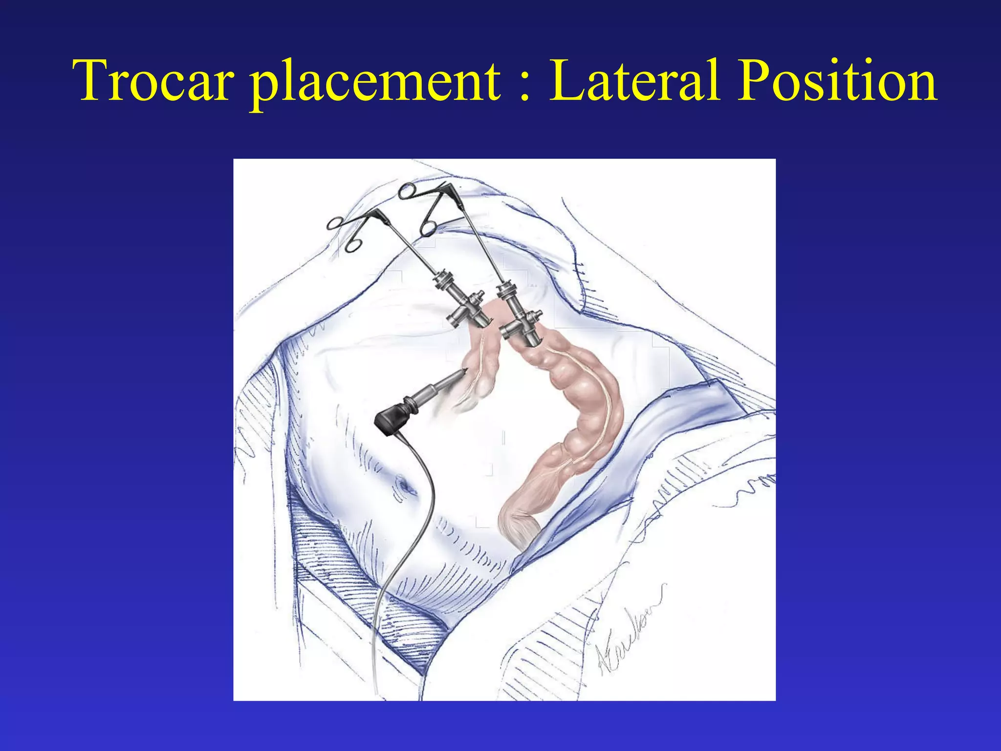 Laparoscopic Sigmoid Colon Resection for Diverticular Disease | PPT