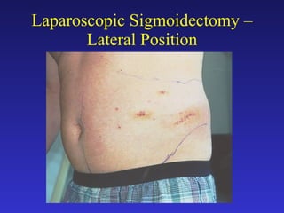 Laparoscopic Sigmoid Colon Resection for Diverticular Disease | PPT