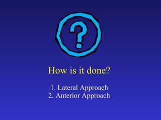 Laparoscopic Sigmoid Colon Resection for Diverticular Disease | PPT