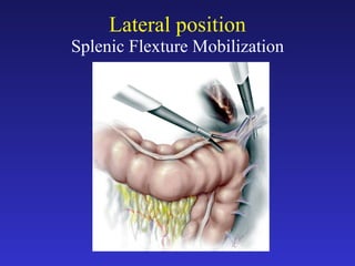 Laparoscopic Sigmoid Colon Resection for Diverticular Disease | PPT