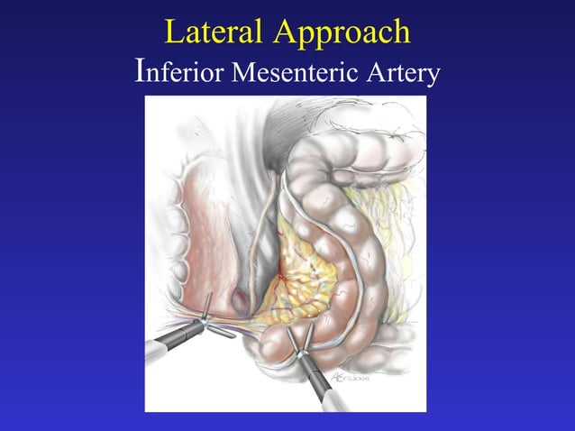 Laparoscopic Sigmoid Colon Resection For Diverticular Disease Ppt