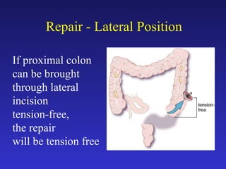 Laparoscopic Sigmoid Colon Resection for Diverticular Disease | PPT