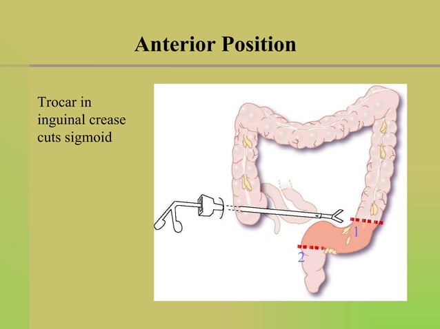 Laparoscopic Sigmoid Colon Resection: Supine and Lateral | PPT | Death ...