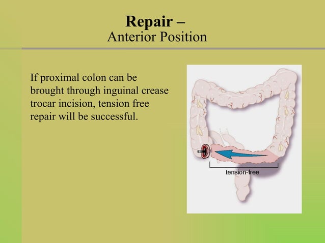 Laparoscopic Sigmoid Colon Resection: Supine and Lateral | PPT | Death ...