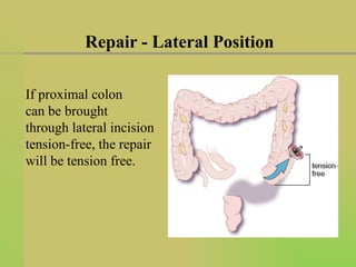 Laparoscopic Sigmoid Colon Resection: Supine and Lateral | PPT