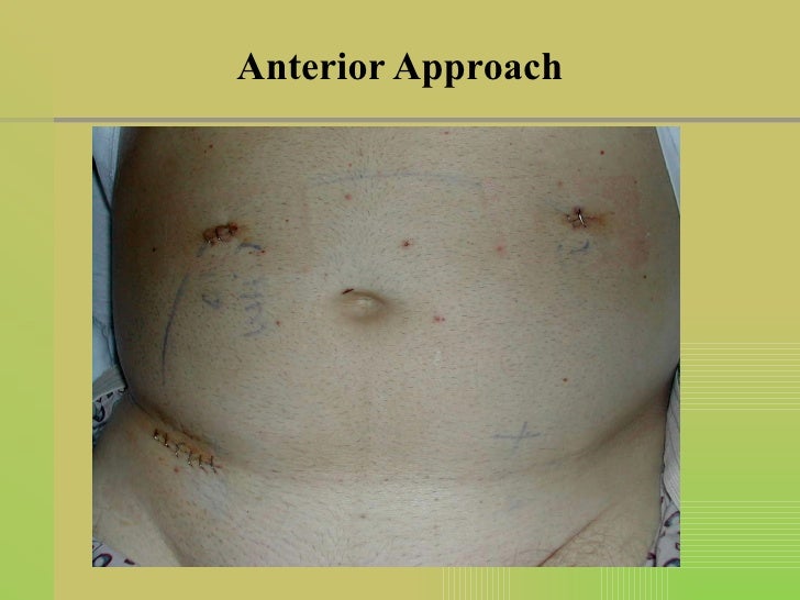 Laparoscopic Sigmoid Colon Resection: Supine and Lateral