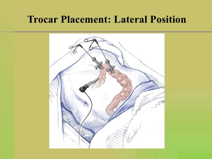 Laparoscopic Sigmoid Colon Resection: Supine and Lateral