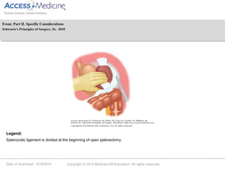 Laparoscopicsplenectomy | PPT