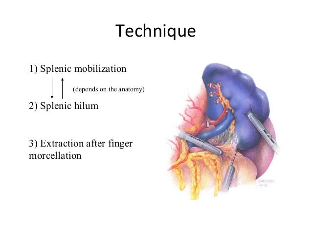 Laparoscopicsplenectomy
