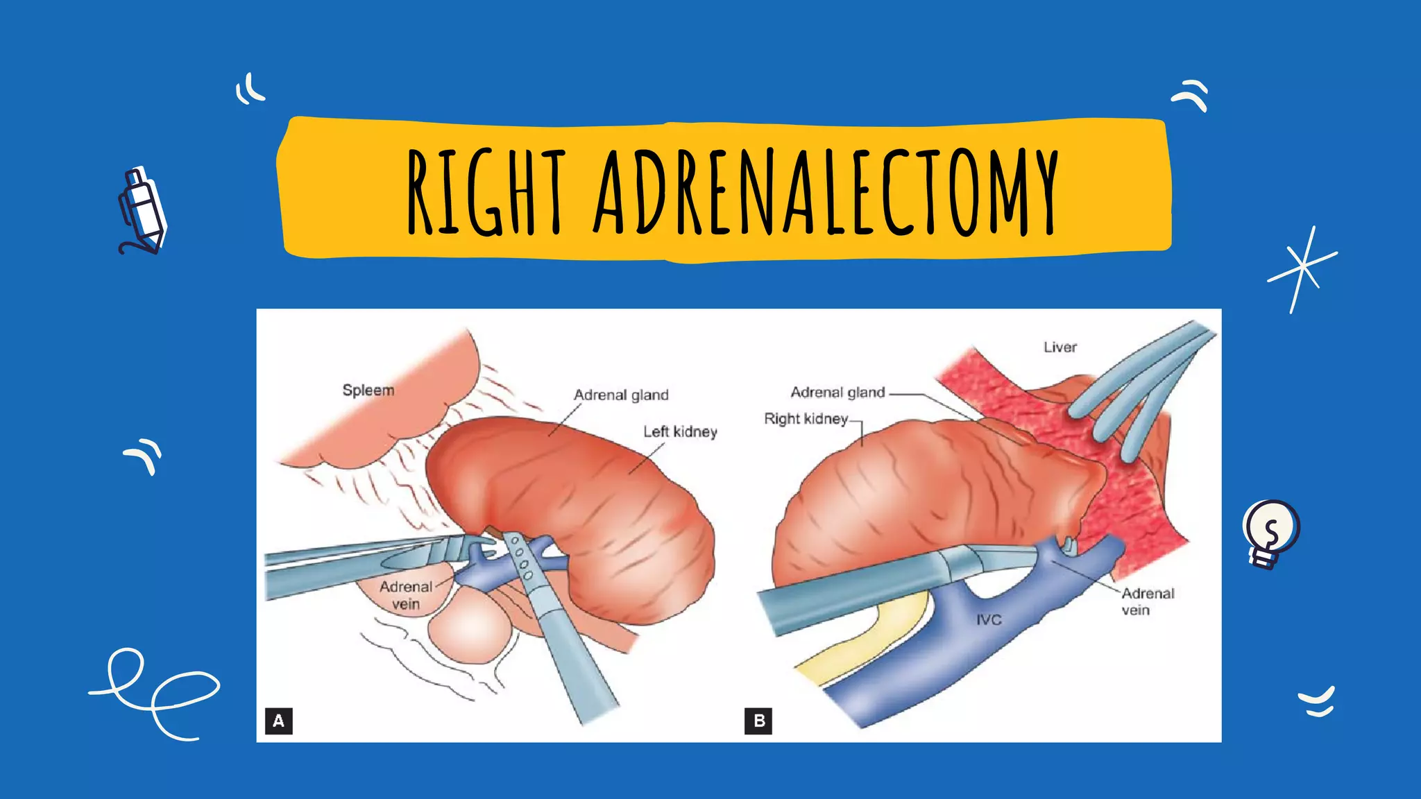 Laparoscopic surgery and Right Adrenalectomy | PDF