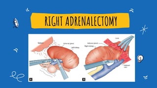 Laparoscopic surgery and Right Adrenalectomy | PDF