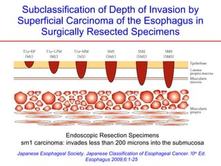 Laparoscopic trans hiatal esophagectomy for early cancer-final | PPT
