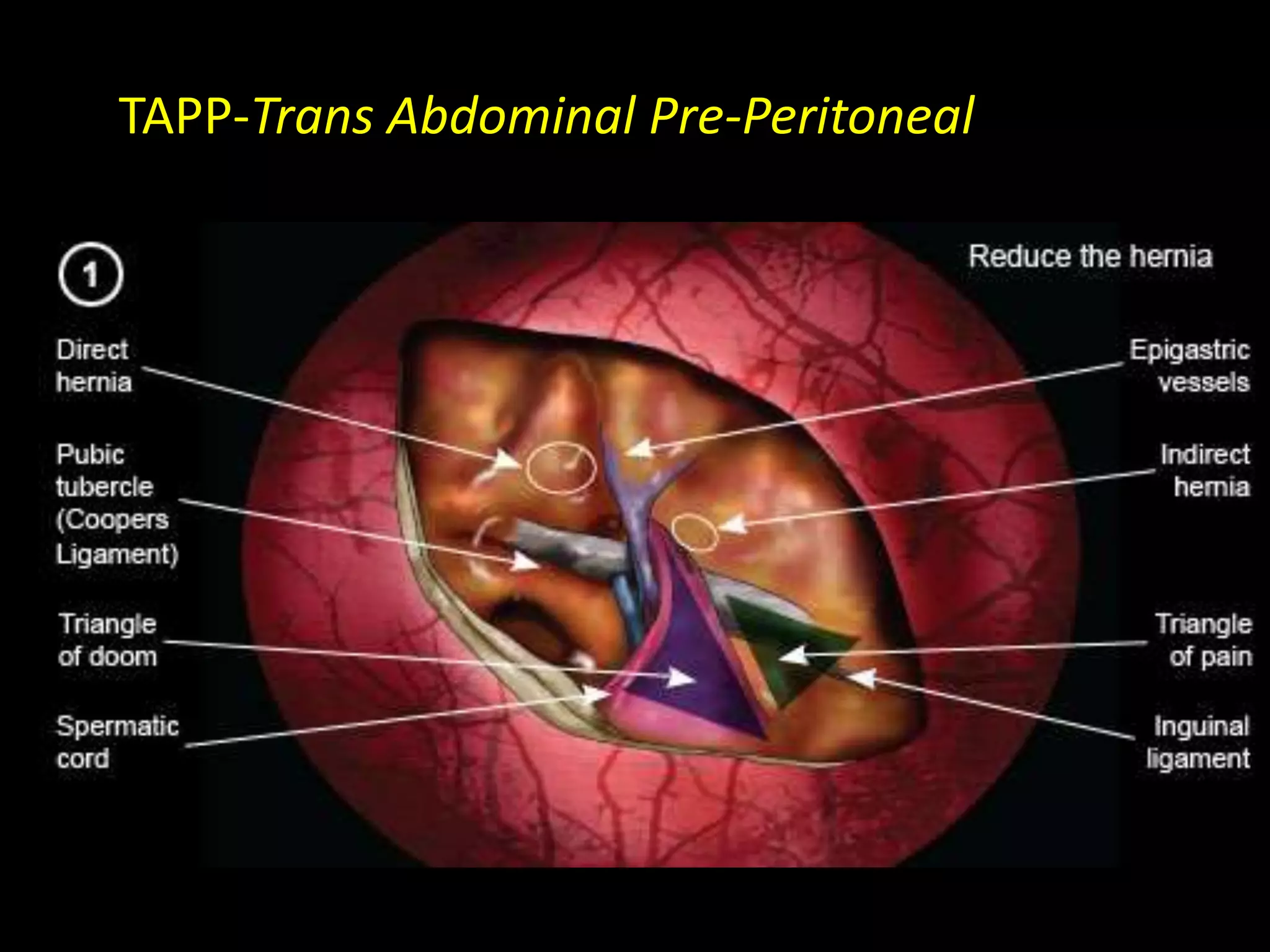 Laparoscopic treatment of groin hernias final | PPT