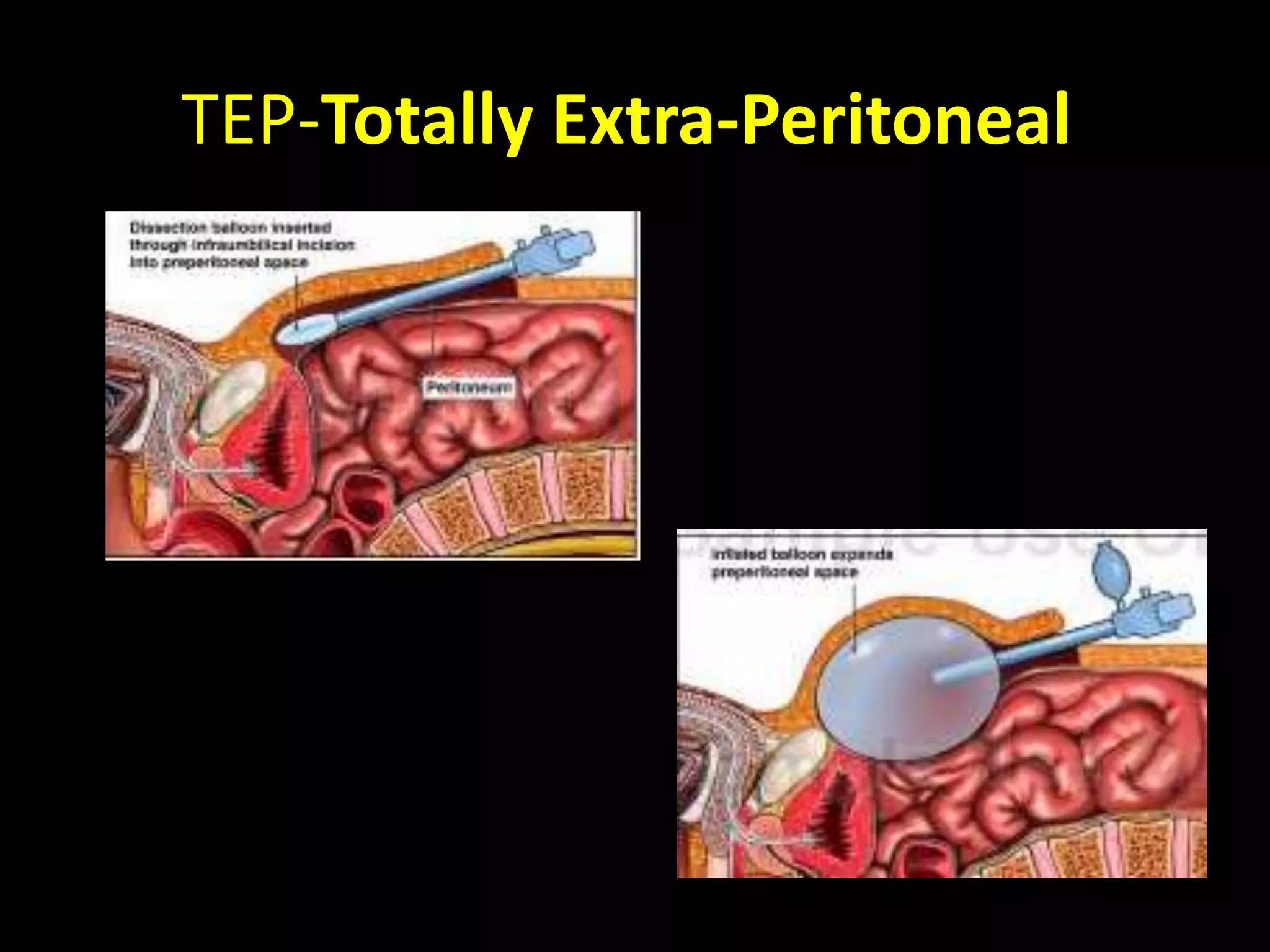 Laparoscopic treatment of groin hernias final | PPT