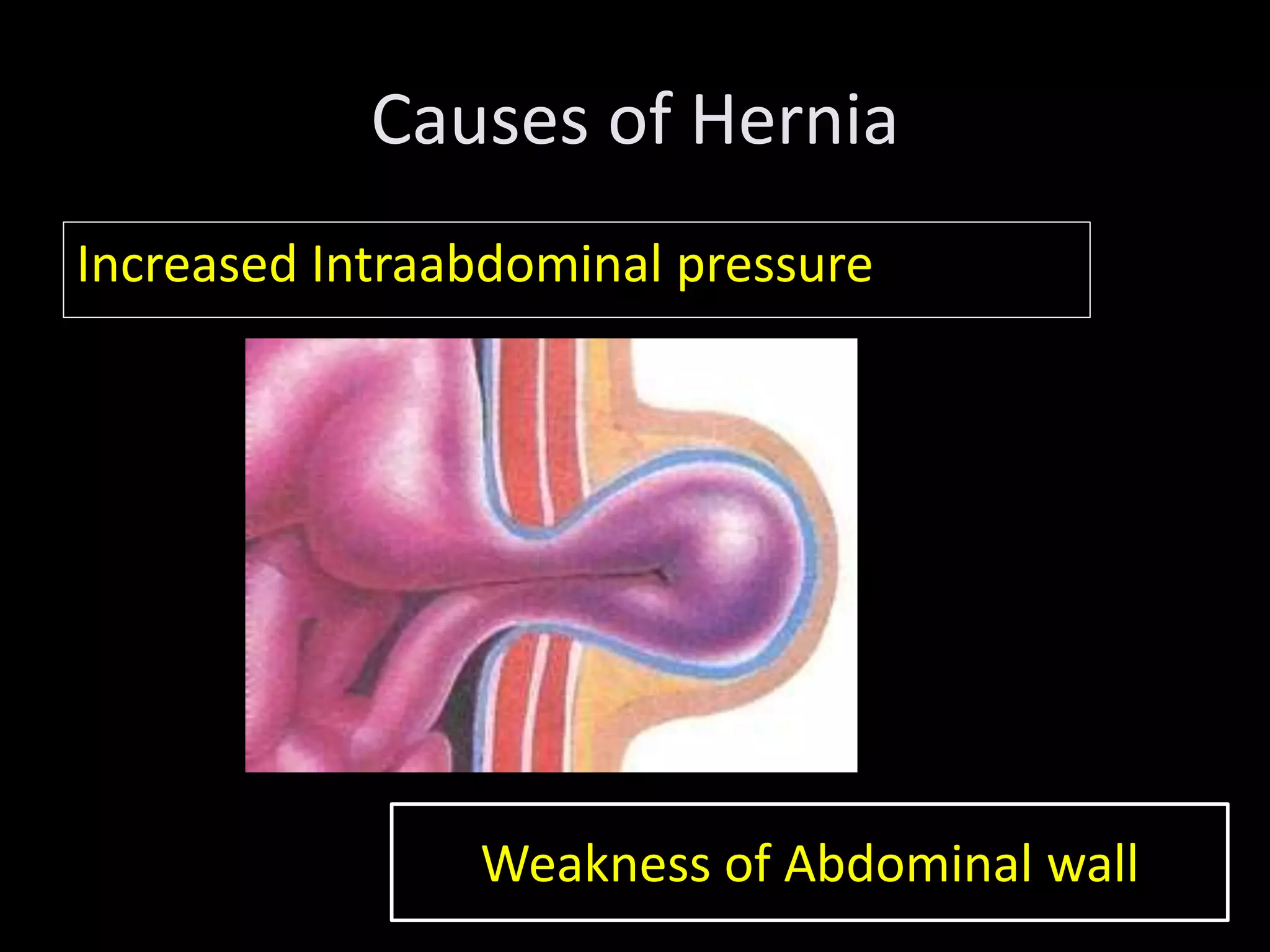 Laparoscopic treatment of groin hernias final | PPT