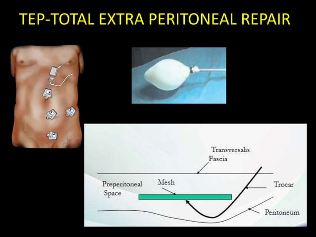 Laparoscopic treatment of groin hernias final | PPT