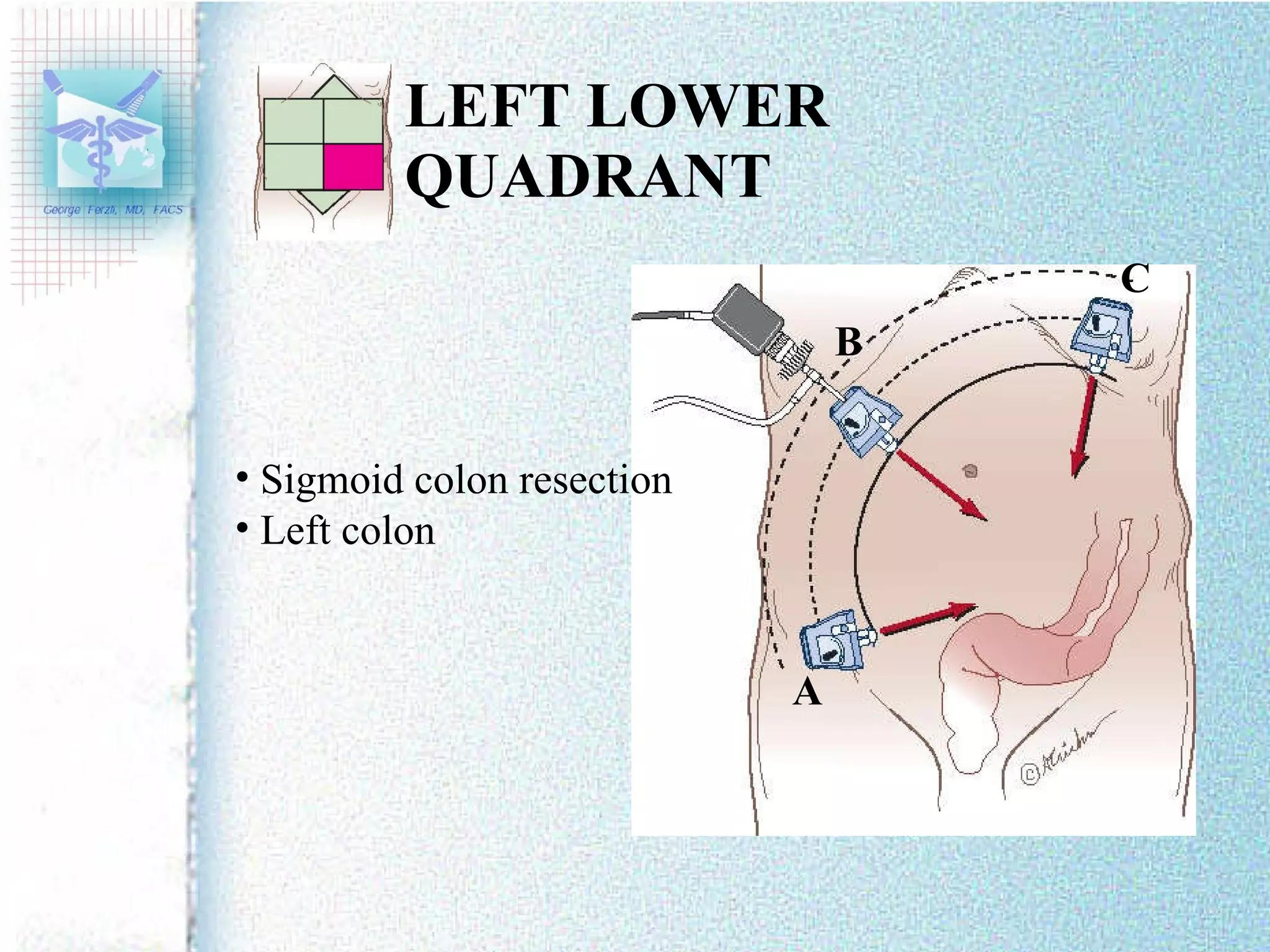 Laparoscopic Trocar Placement | PPT