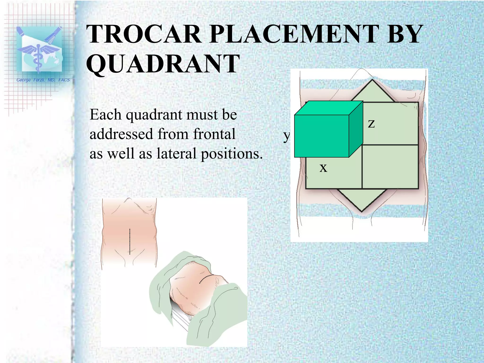 Laparoscopic Trocar Placement | PPT