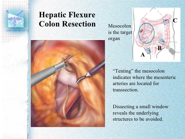 Laparoscopic Trocar Placement