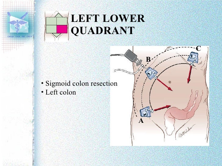Laparoscopic Trocar Placement