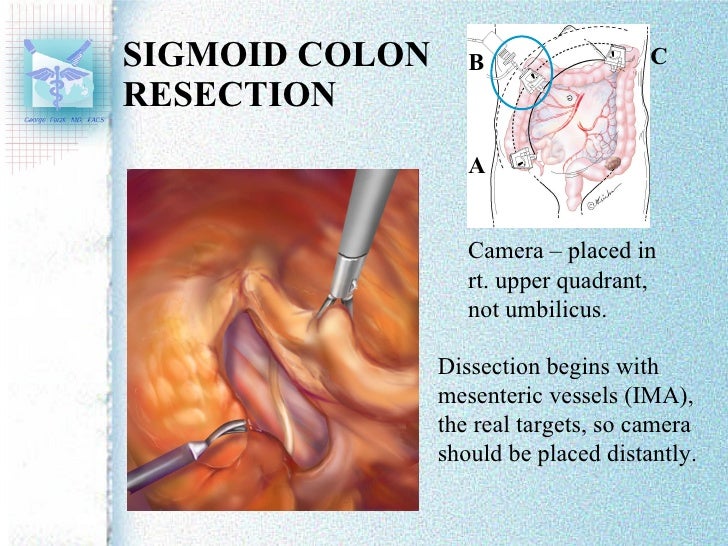 Laparoscopic Trocar Placement