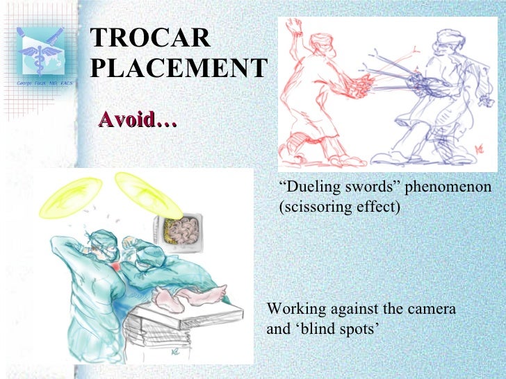 Laparoscopic Cholecystectomy Trocar Placement Techniques Of