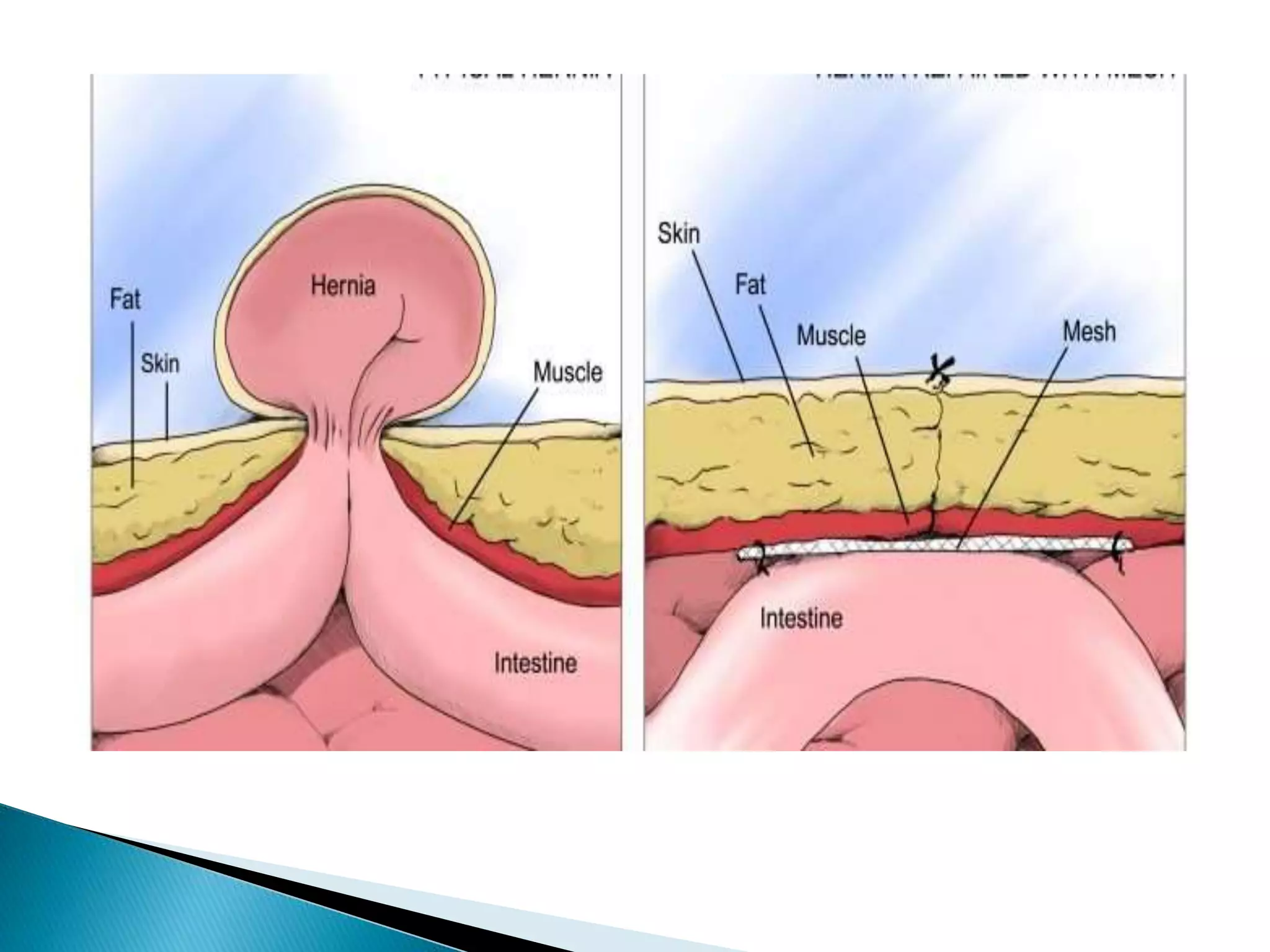 Laparoscopic umbilical hernia repair | PPTX