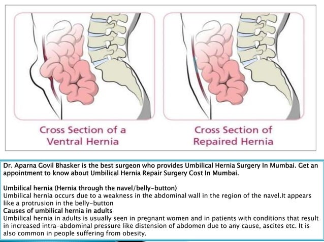 Laparoscopic umbilical hernia repair