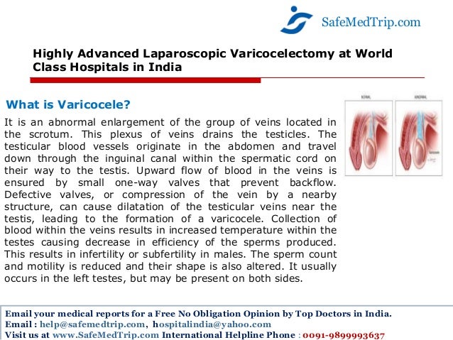 Highly Advanced Laparoscopic Varicocelectomy At World Class Hospital