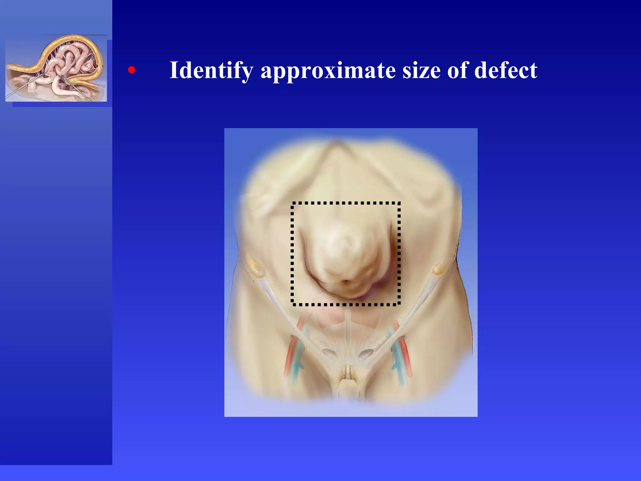 Laparoscopic Ventral Hernia Repair Ppt Free Download