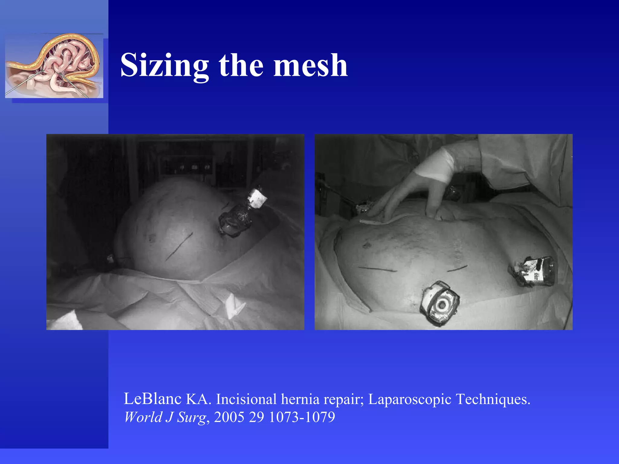 Laparoscopic Ventral Hernia Repair Ppt Free Download