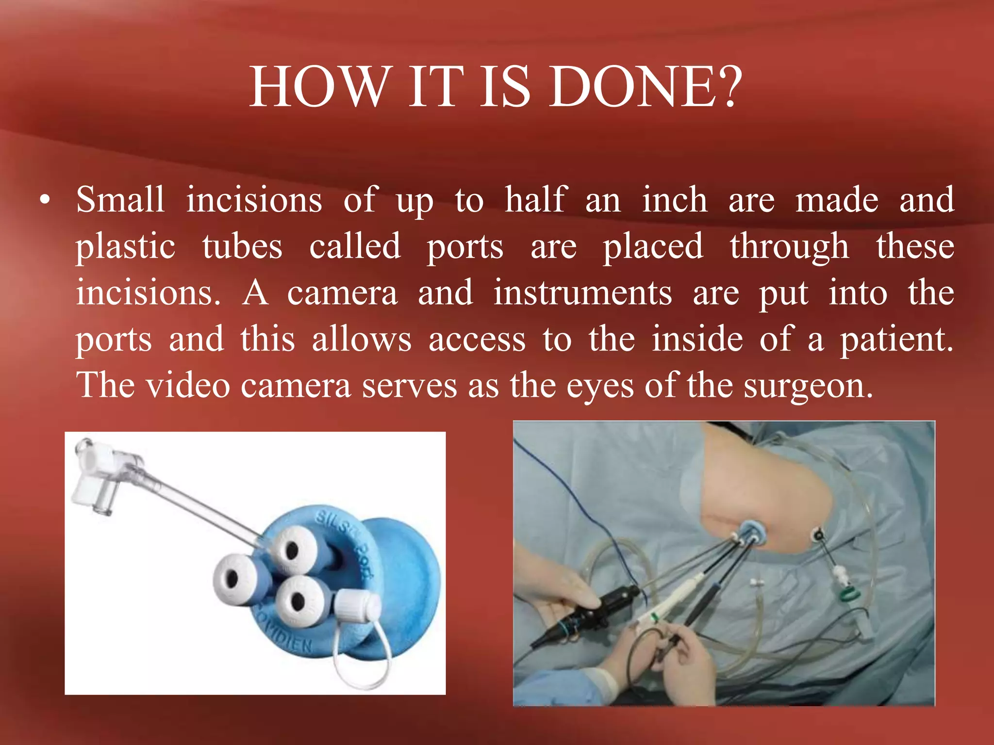 Laparoscopy | PPTX