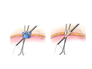 Basic of Laparoscopy | PPTX