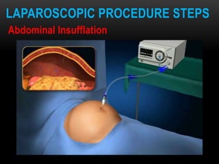 Laparoscopy | PPTX