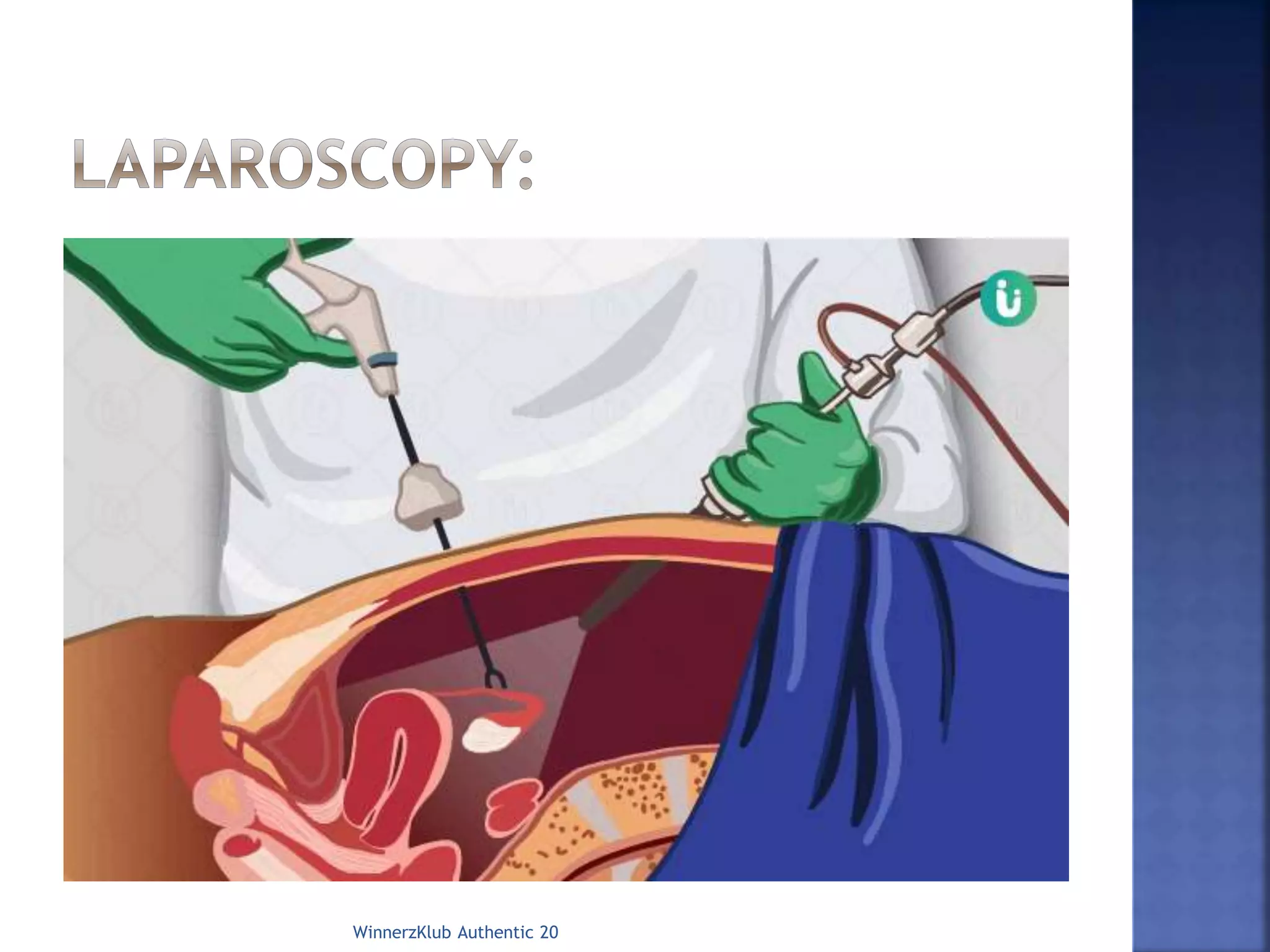 Diagnostic Laparoscopy | PPTX